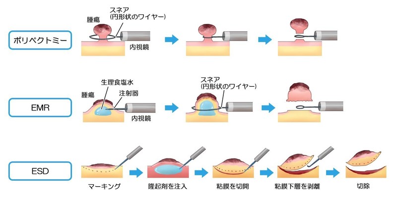 大腸がんの手術治療―内視鏡治療・腹腔鏡手術 | メディカルノート
