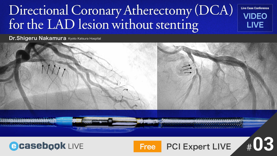 VIDEO: Directional Coronary Atherectomy (DCA) for the LAD lesion ...