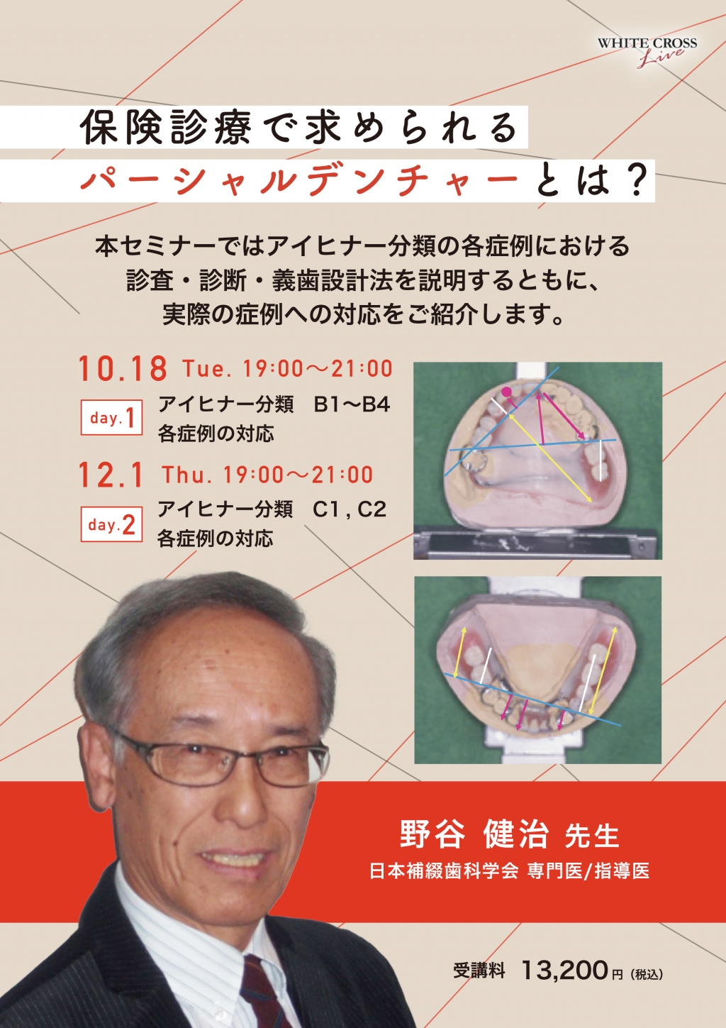 [録画配信]保険診療で求められるパーシャルデンチャーとは？ | WHITE CROSS