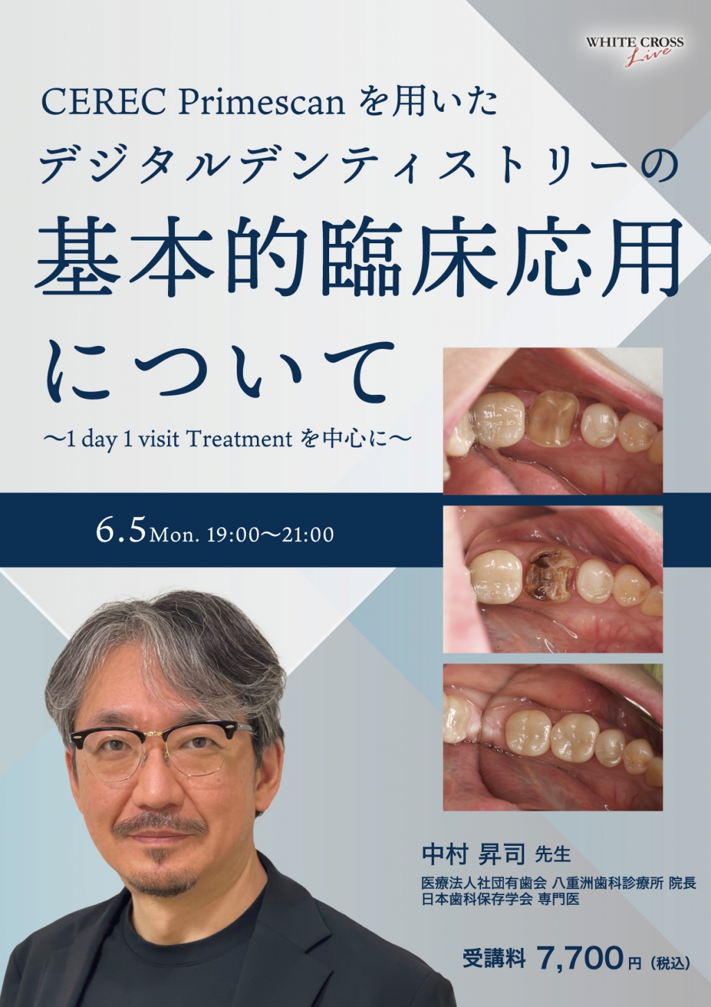 [録画配信]CEREC Primescanを用いたデジタルデンティストリーの基本的臨床応用について | WHITE CROSS