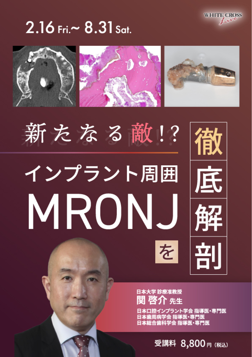 [VOD]新たなる敵 ！？「インプラント周囲MRONJ」を徹底解剖 | WHITE CROSS