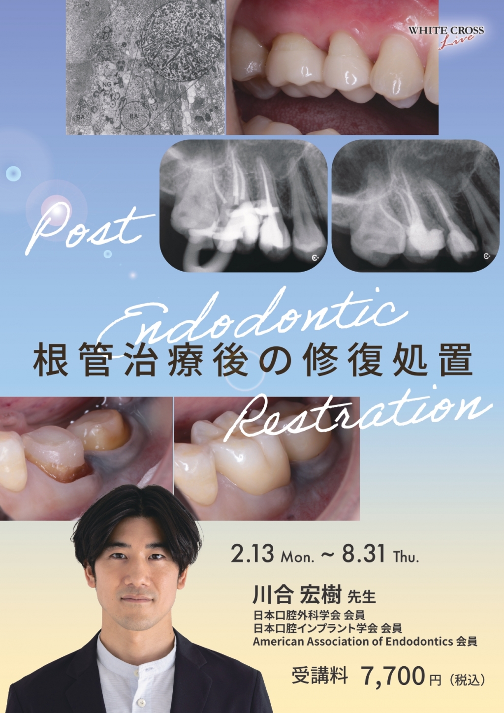 [VOD]Post Endodontic Restration 根管治療後の修復処置 | WHITE CROSS