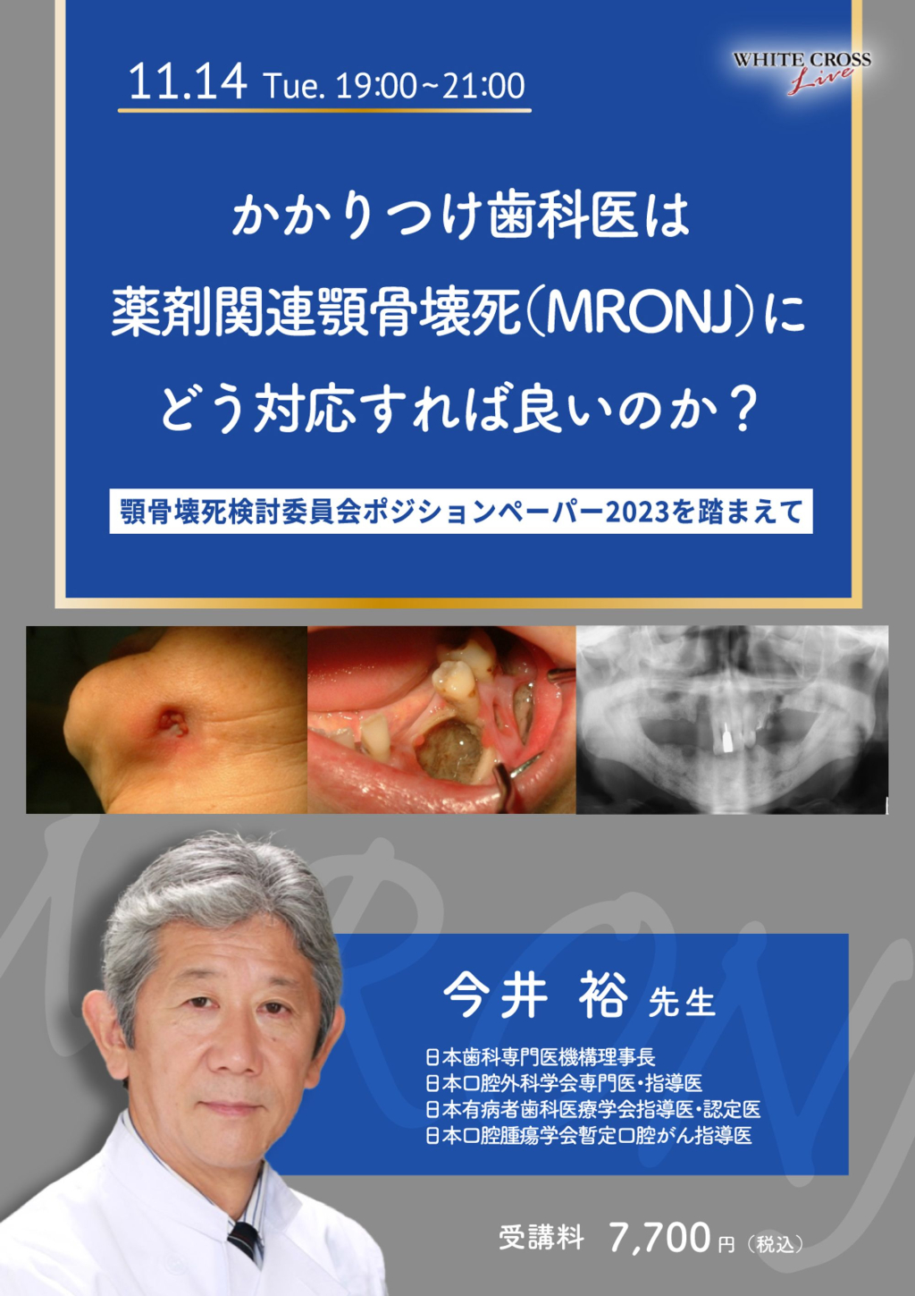 [録画配信]かかりつけ歯科医は薬剤関連顎骨壊死（MRONJ）にどう対応すれば良いのか？ | WHITE CROSS