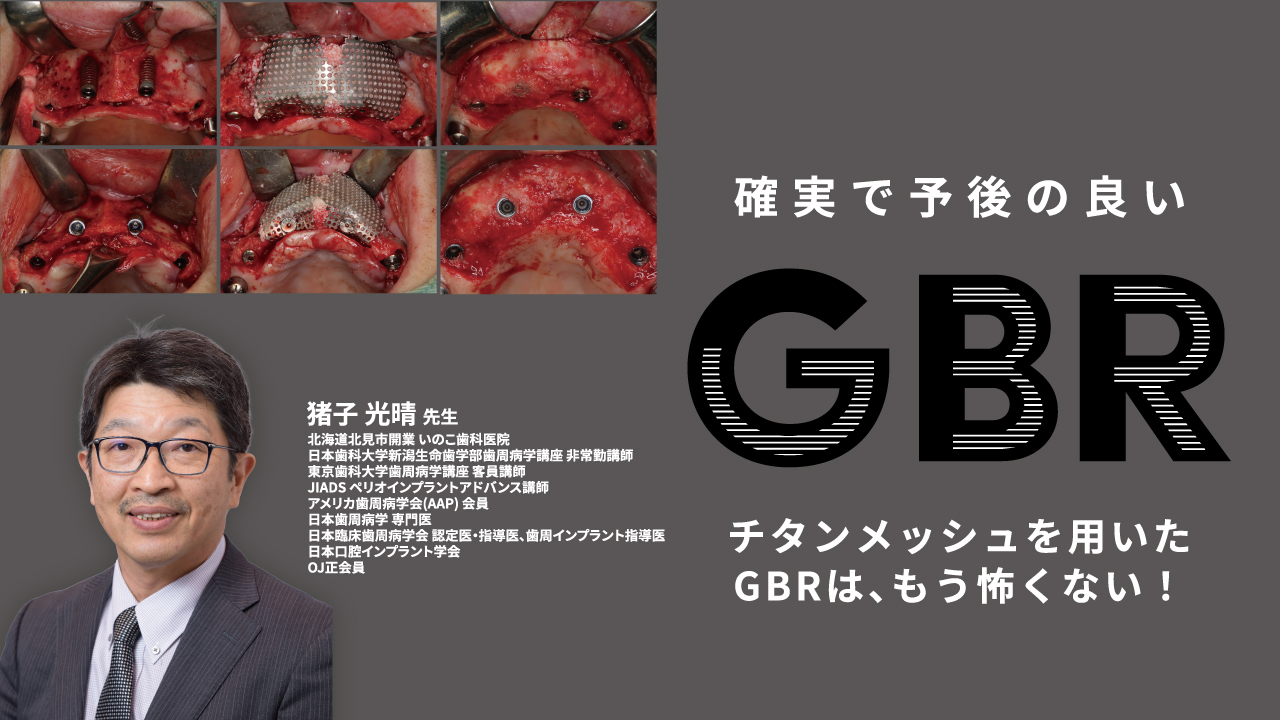 確実で予後の良いGBR〜チタンメッシュを用いたGBRは、もう怖くない！〜 | WHITE CROSS